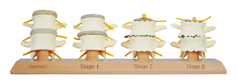 3 Stage Spinal Degeneration Model – Smart Practice Australia